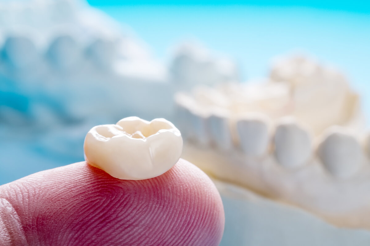 How Much Tooth Structure Is Needed For A Crown? - A&R Advanced Dental Group